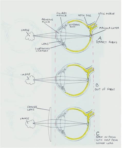 Long Sightedness Farsightedness Hyperopia Or Hypermetropia The Basics