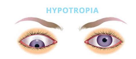 Strabismus Nurses Revision