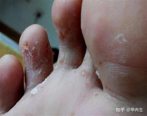什么是糜烂型脚气 知乎