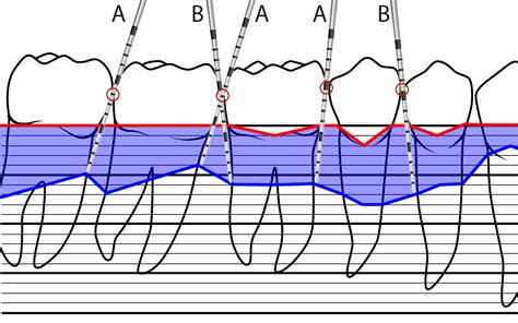 Periodontal Chart Online Perio