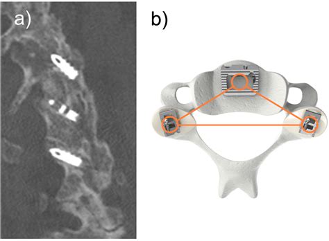 Clinical Implementation Of Tissue Sparing Posterior Cervical Fusion Addressing Market Access