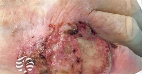 Pyoderma Gangrenosum Image