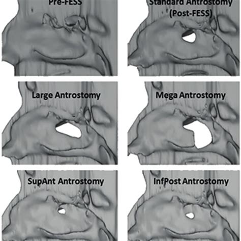 Coronal Ct Image Showing Figure Coronal Ct Showing Retroverted Download Scientific Diagram