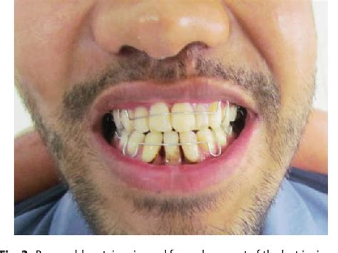 Figure 2 From Mandibular Symphyseal Parasymphyseal Fracture With Incisor Tooth Loss Preventing