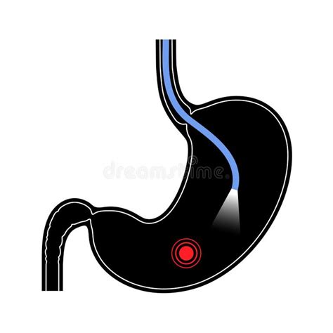 Gastroscopy Endoscopy Procedure Stock Vector Illustration Of Endoscopy Vector 281230464