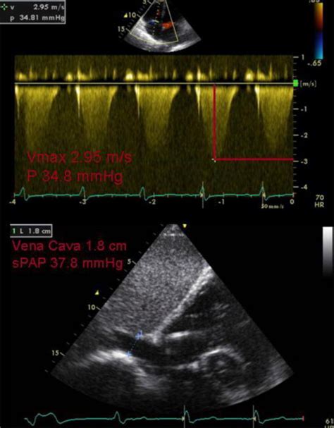 Pulmonary Hypertension And Pulmonary Artery Acceleration Time A