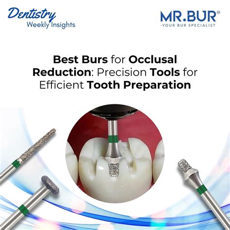 Understanding Dental Pulp Diseases Root Canal Therapy And Advanced End