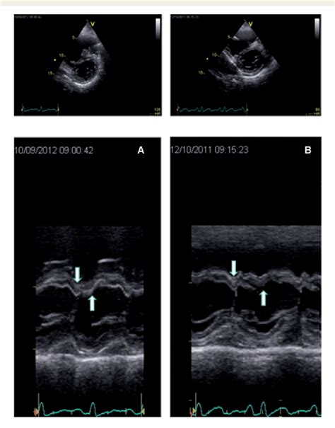 Figure 1 From The Overloaded Right Heart And Ventricular