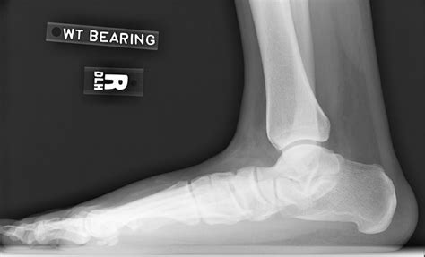 Tendinose Tibial Posterior E Tenossinovite Tibial Posterior Tendinose Tibial Posterior E