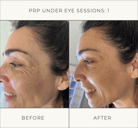 Prp Under Eye Treatment Professionals In Melbourne Plasma Therapy