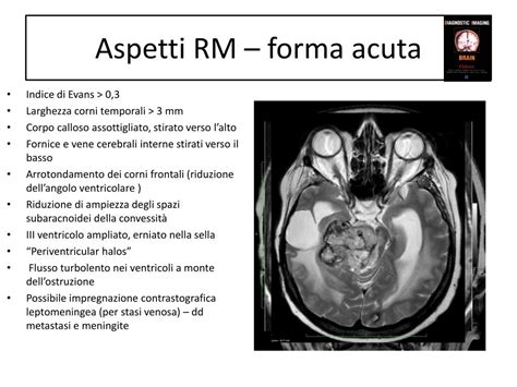 Ppt Idrocefalo Powerpoint Presentation Free Download Id1330850
