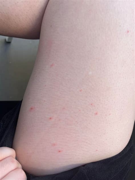 Is This Scabies Need Advice Rscabies