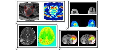 A Cervix Tumor Delineated On Anatomical Image And Projected Onto Download Scientific Diagram