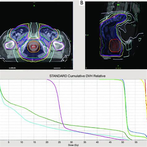 Simultaneous Integrated Boost Intensity Modulated Radiotherapy
