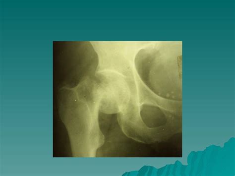 Презентация на тему Оскольчатый чрезвертельный аддукционный перелом правой бедренной кости