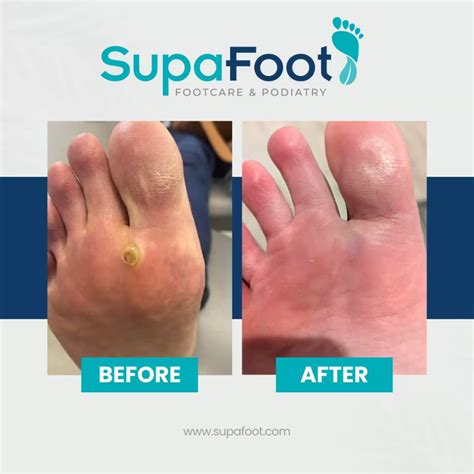 Swift Verruca Treatments Cheltenham Supafoot