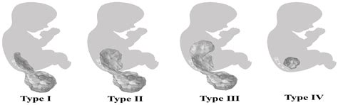 Immature Sacrococcygeal Teratoma A Case Report And Extensive Review Of