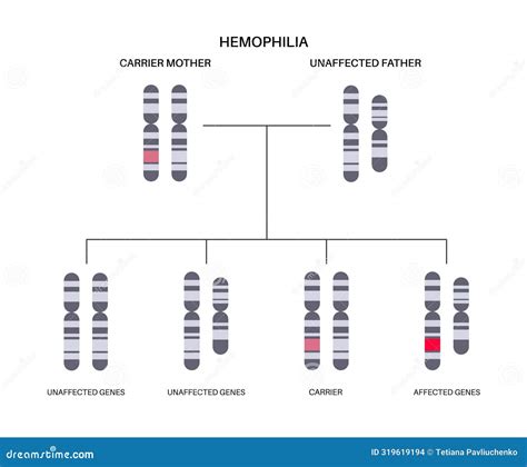 Hemophilia Disease Graph Vector Illustration 319619194