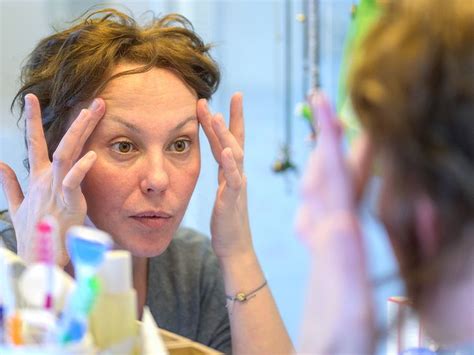 Pimples On Eyebrows Causes Treatment And Prevention