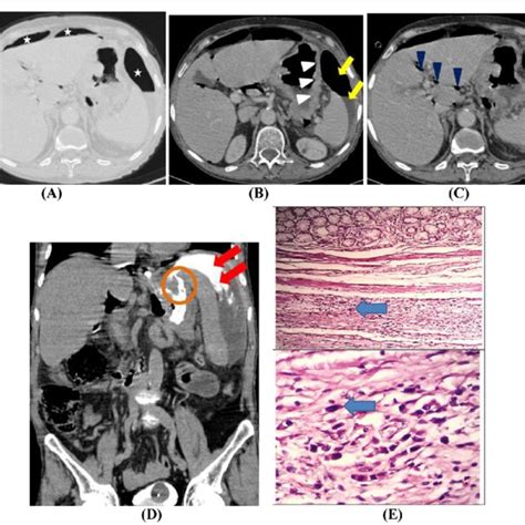 Scaphoid Fracture Classification According To Herbert And Fischer