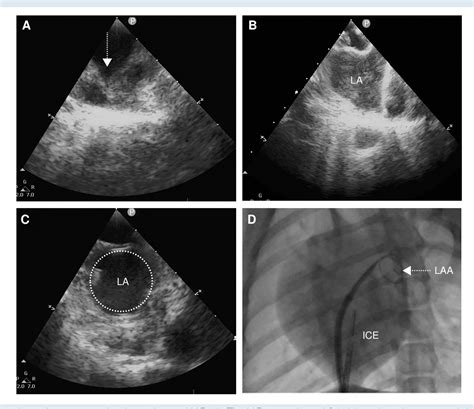 Figure 2 From Safety And Efficacy Of The Second Generation Cryoballoon For Left Atrial Appendage