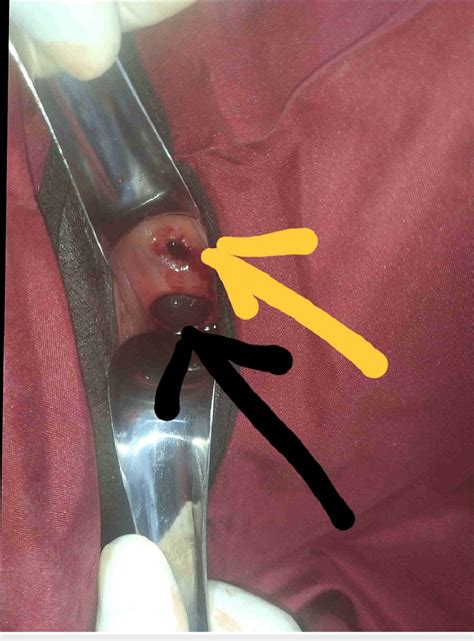 Exposed Cervix With A Yellow Arrow Pointing To The External Os And The Download Scientific