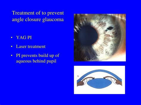 Ppt Ophthalmic Emergencies Powerpoint Presentation Free Download