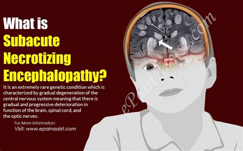 What Is Subacute Necrotizing Encephalopathy And How Is It Treated