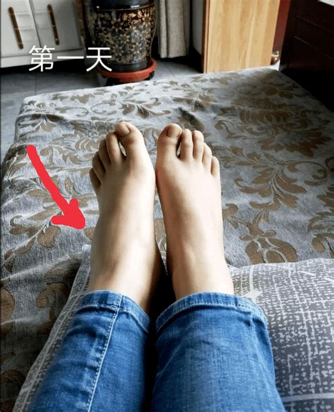 崴脚的第二天这也肿得太可怕了吧你们说我是不是要截肢了 大哥
