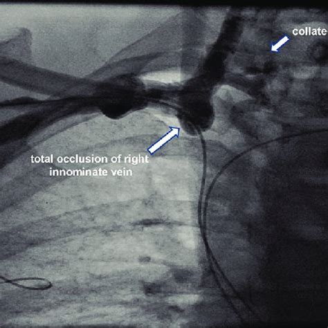 Pdf Complete Occlusion Of Subclavian Venous Access An Unexpected Troubleshoot During