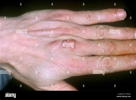 Rheumatoid Nodules Palms