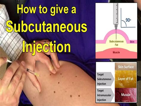 Types Of Injection Routes Pptx Skin And Dermatology Diseases And Conditions