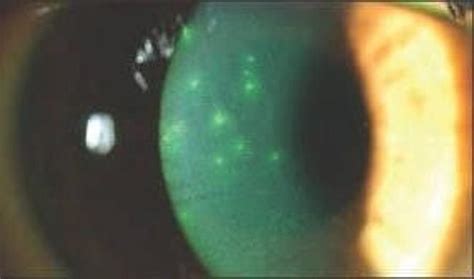 Adenoviral Keratitis