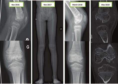 Limb Length Discrepancy And Chondropathy After A Septic Arthritis Of
