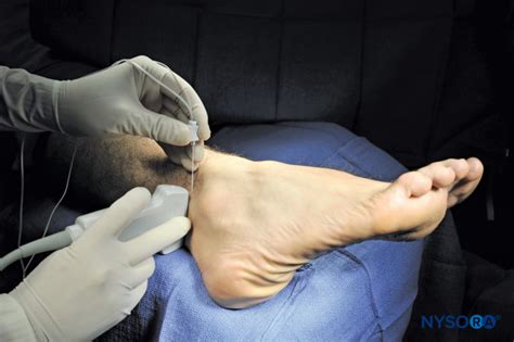 Ultrasound Guided Ankle Nerve Block NYSORA