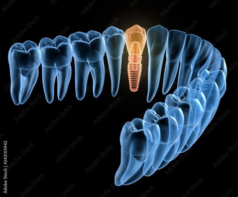 Premolar Tooth Recovery With Implant X Ray View Medically Accurate 3d Illustration Of Human