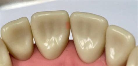 Class Iii Composite Preparation My Dental Key Class Iii Composite Preparation My Dental Key