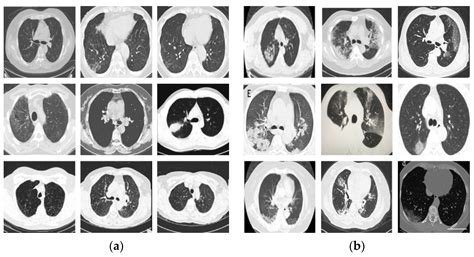 Deep 3d Volumetric Model Genesis For Efficient Screening Of Lung