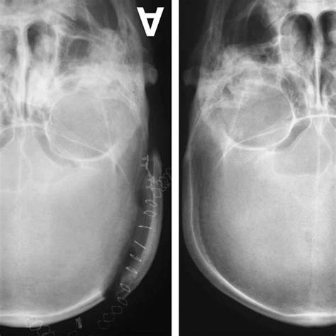 A Radiograph Showing That The Left Superior Edge Of The Bone Flap Had