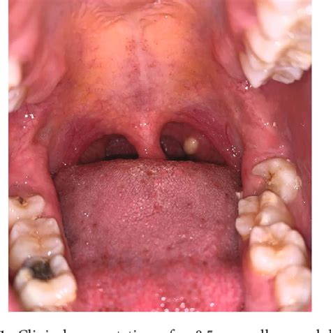 Bumps On Tonsils