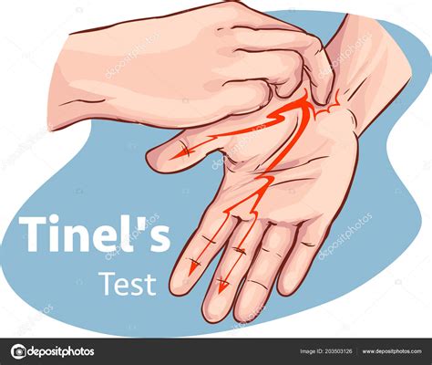 Ilustração Vetorial Teste Tinel Vetor De © 203503126