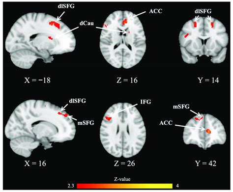 Brain Activation Results From The Bold Fmri Analysis Of The Contrast