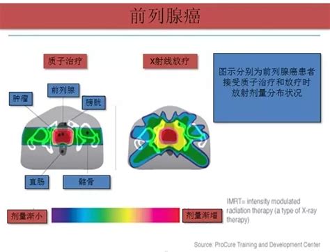 为什么前列腺癌最适合进行质子治疗 赴美就医 远程会诊 大通福克斯美国本土机构