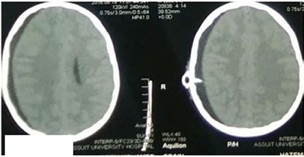 Subdural Hygroma Different Treatment Modalities And Clinical Outcome