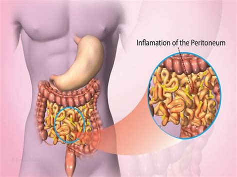 Peritonitis Pptx
