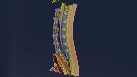 Intervertebral Herniation Slipped Ruptured Disc Superhive Formerly