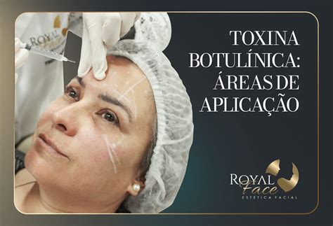 Botox No Rosto Regiões De Aplicação E Efeitos
