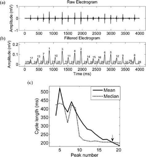 Figure 1 From Iterative Method To Detect Atrial Activations And Measure Cycle Length From