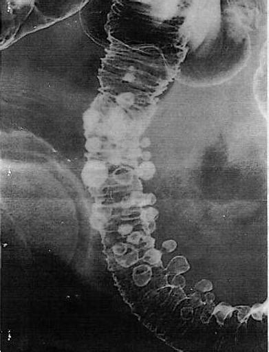 Imagen Endoscópica De Colon Sigmoides Con Divertículos Download Scientific Diagram