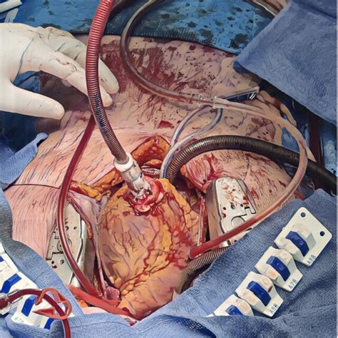 Lv Apical Cannula In Situ Lv Left Ventricular Download Scientific Diagram